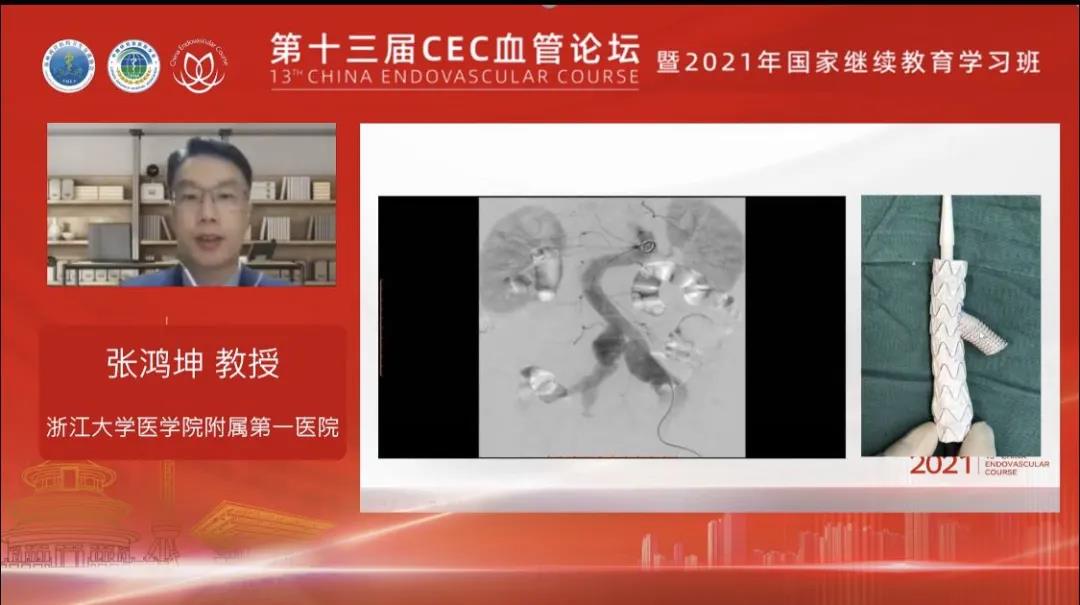 「会后直击」先见·聚焦腔内重建髂内动脉——先健专场活动@CEC2021