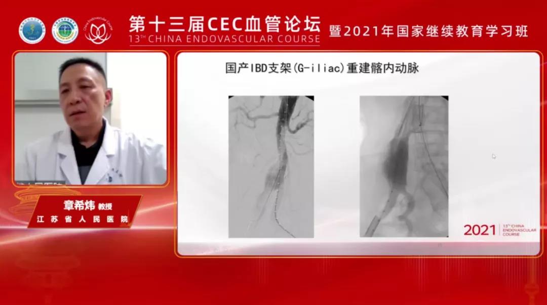 「会后直击」先见·聚焦腔内重建髂内动脉——先健专场活动@CEC2021