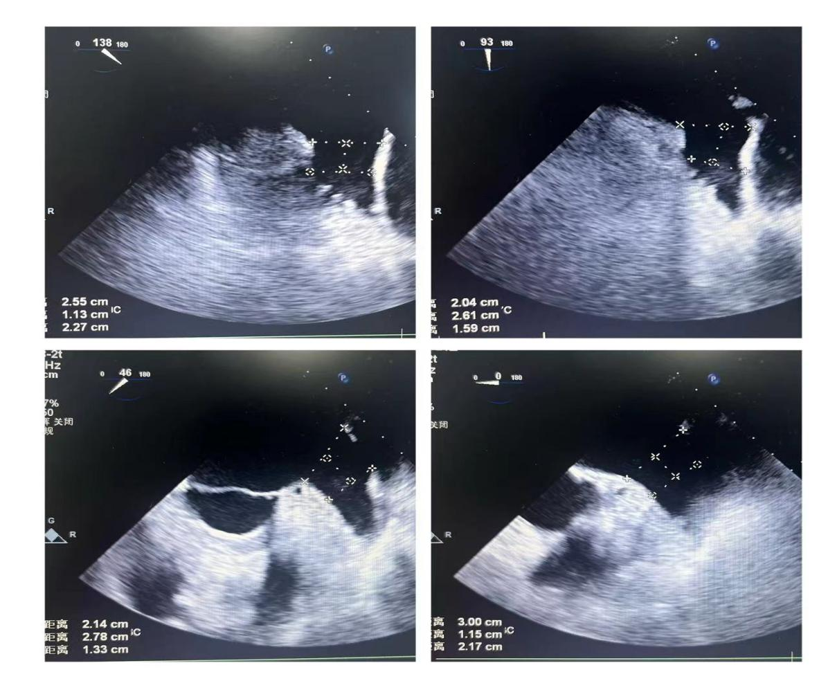 新术式，新组合 | 阜外深圳医院结构心团队运用LAmbre™+LAnavi™创新组合成功开展华南首例纯TEE引导下的LAAC手术
